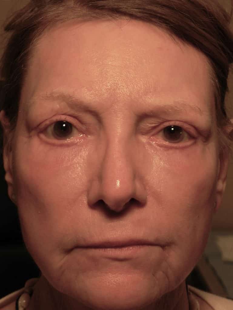 RESET® Skin Resurfacing – Adam Scheiner MD | Dr. Adam Scheiner